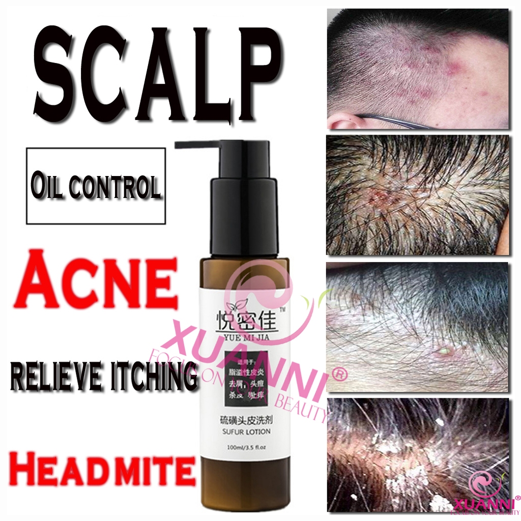 Scalp folliculitis Red and swollen acne Anti-dandruff and antiitchy ...