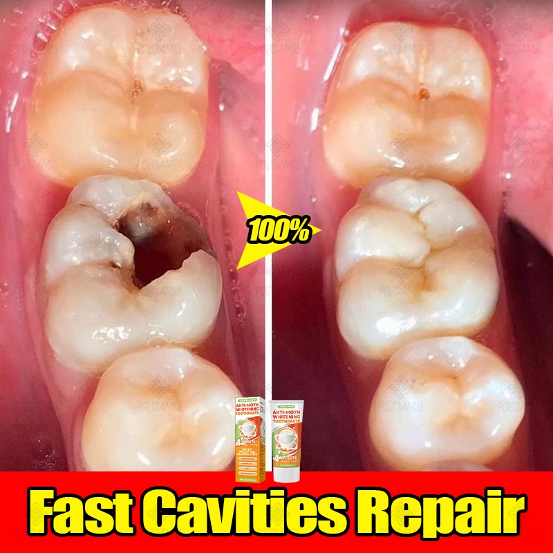 Toothpaste for repairing cavities, caries, dental plaque, toothpaste ...