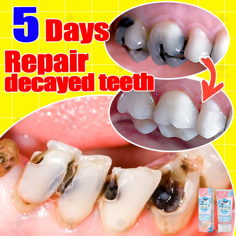 Toothpaste for fighting tooth decay and effective teeth whitening ...