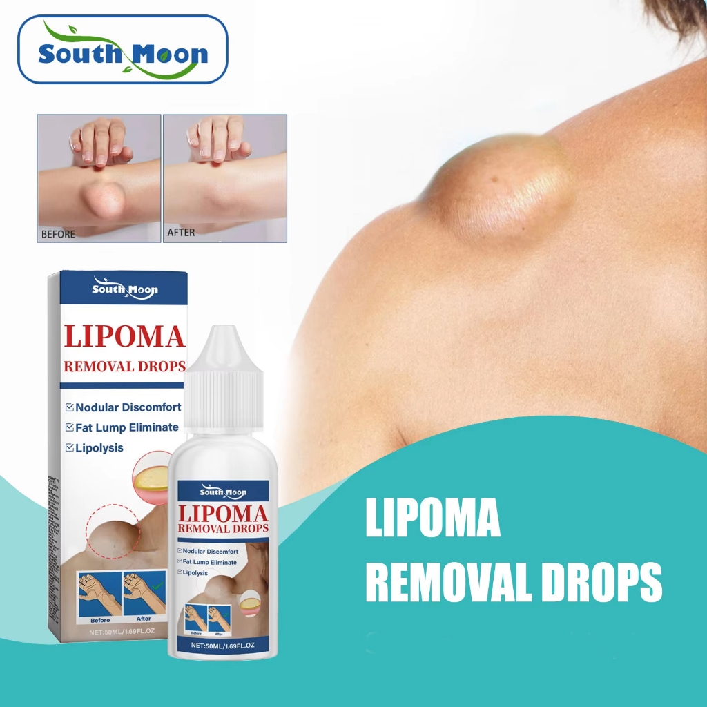South Moon Lipoma Removal Drops Subcutaneous Lumps Treatment Lump ...