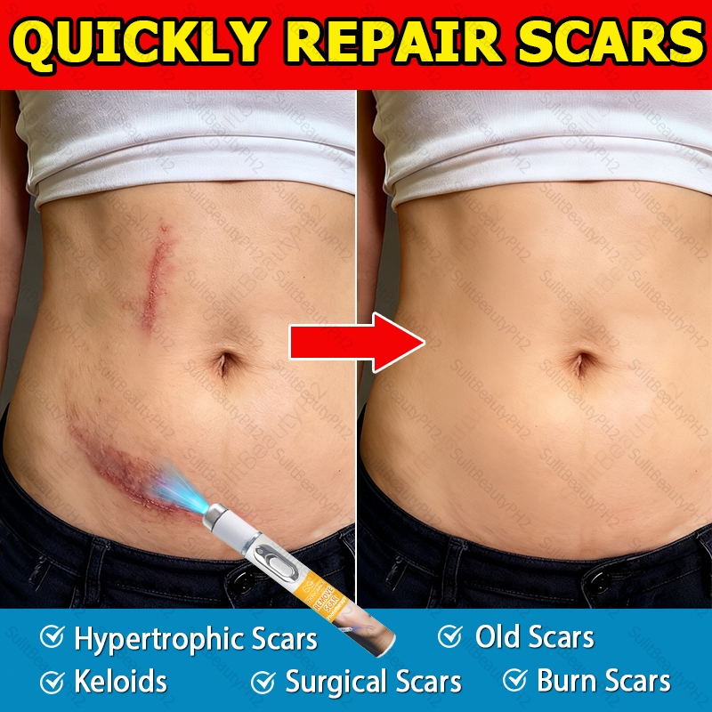 Scar remover effective Suitable for new and old scars, hypertrophic ...