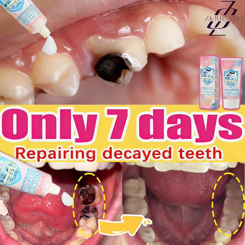 [Money-back guarantee if ineffective] Repair cavities in 1 second, help ...