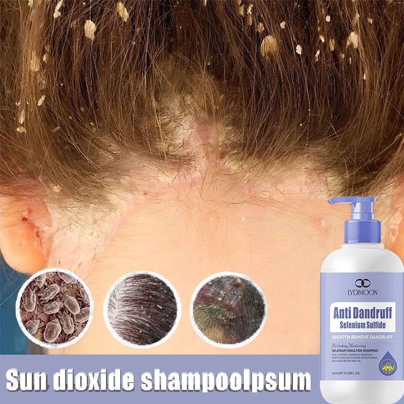 LYDIMOON selenium sulfide shampoo cleanses and removes dandruff ...
