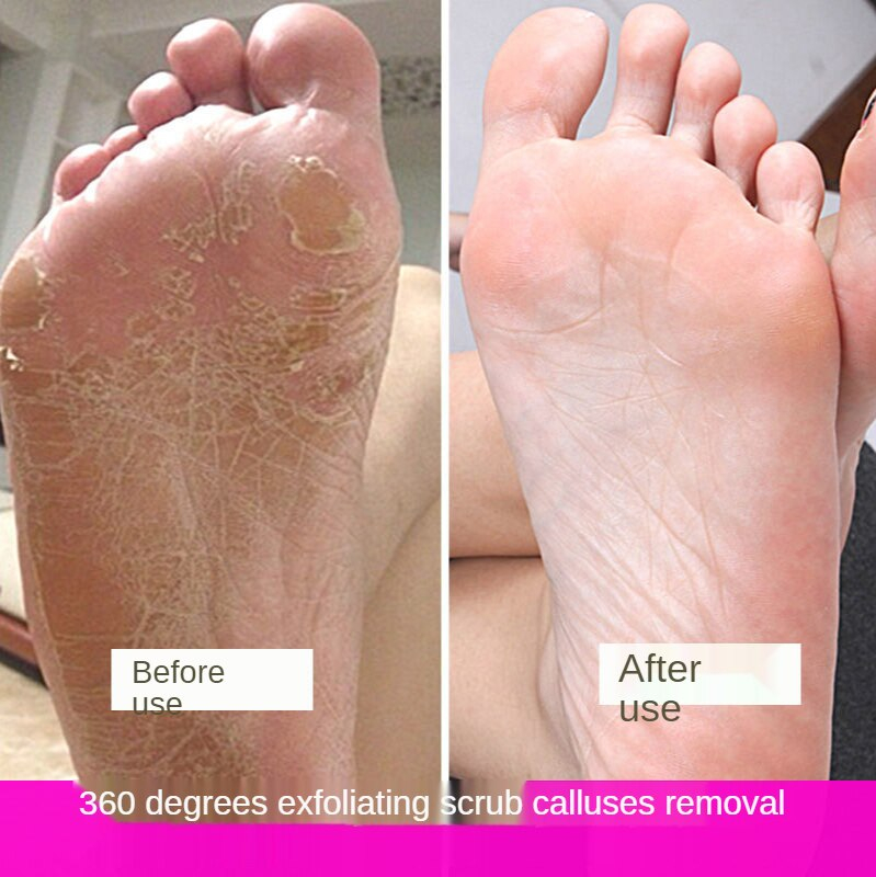 【COD & Ready Stock】Foot callus remover foot spa foot scrub care set 360 ...