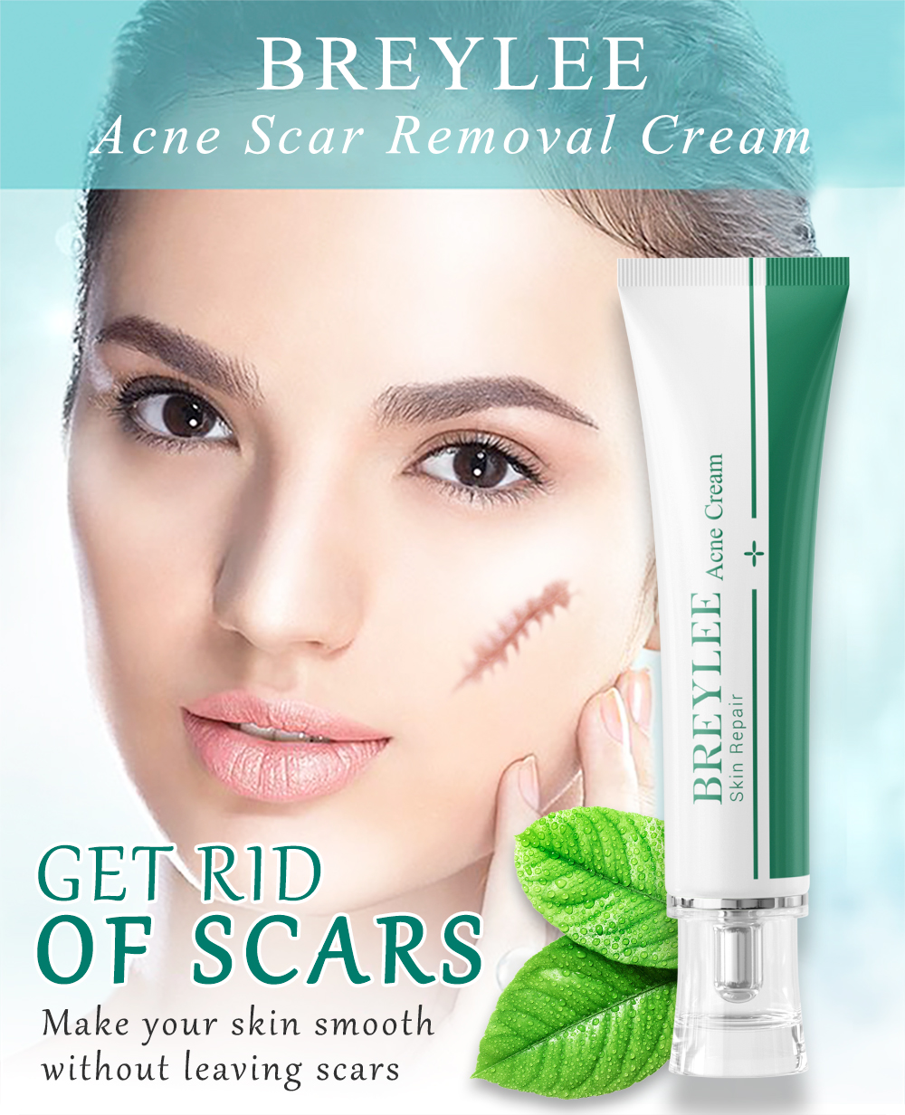 BREYLEE Acne Scar Removal Cream Treatment Remove Stretch Marks Acne Scar Skin 30g | Shopee ...
