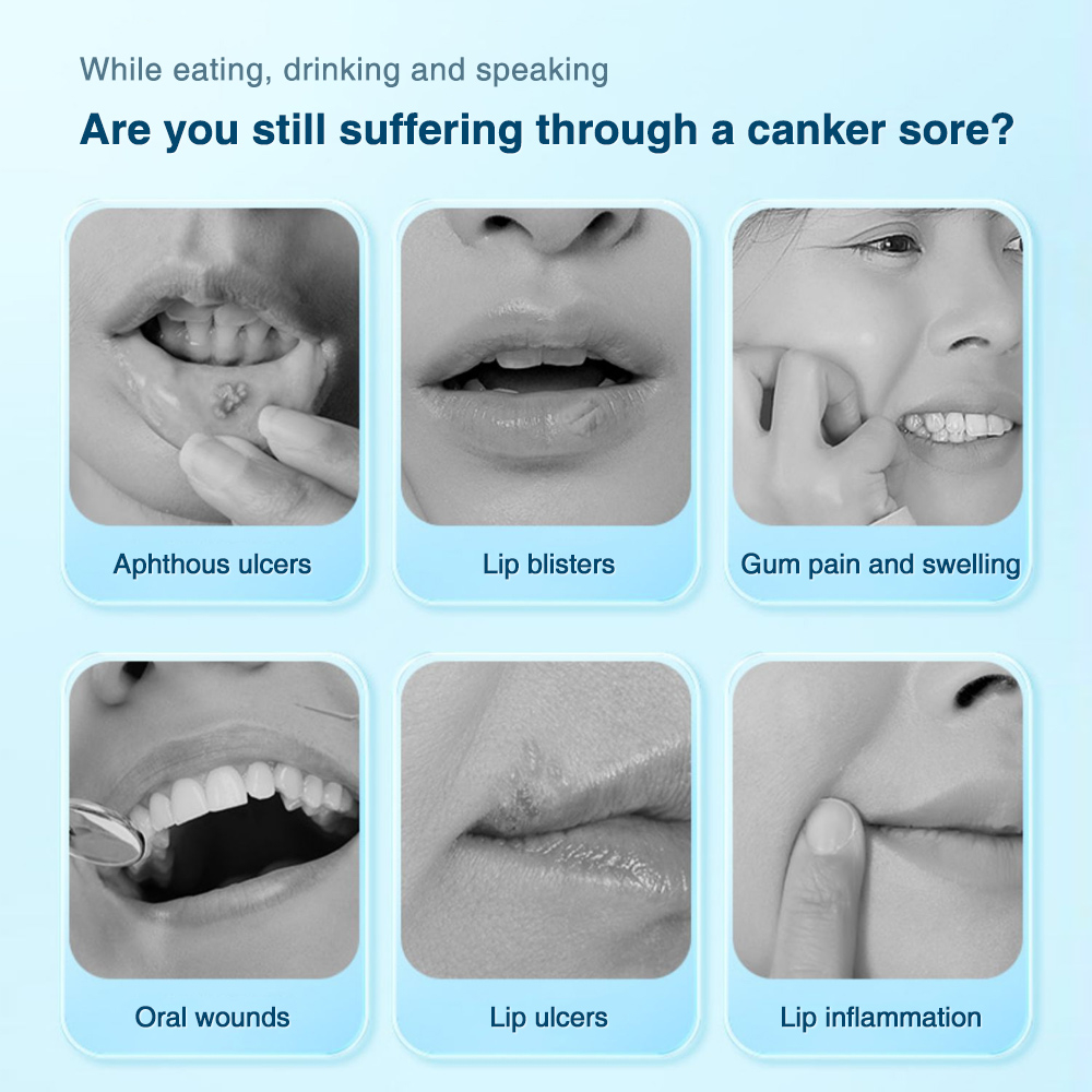 Cofoe Oral Ulcer Gel Mouth Ulcer Treatment Canker Pain Relief Aphthous ...