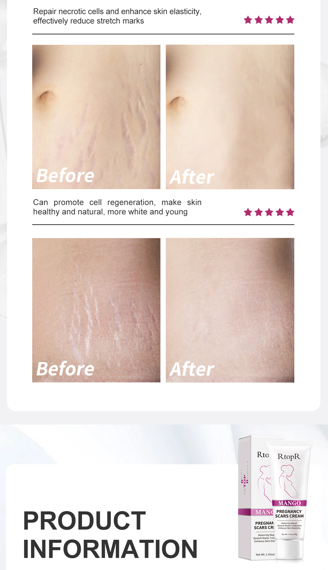 RtopR Stretch Mark Cream for Expecting Mothers, Moisturizing Prenatal ...