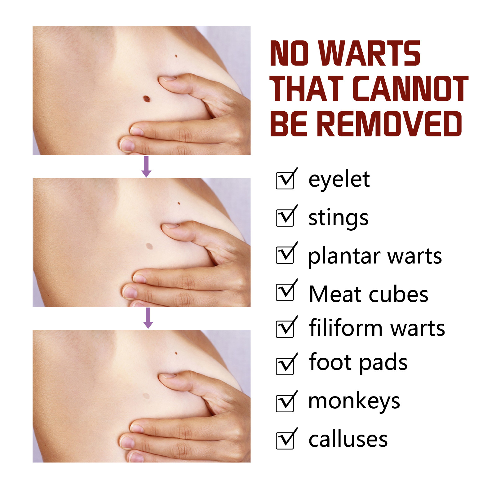 Jaysuing 3ml Wart Removal Liquid Pen Flat Warts Removal Care Pen Skin ...