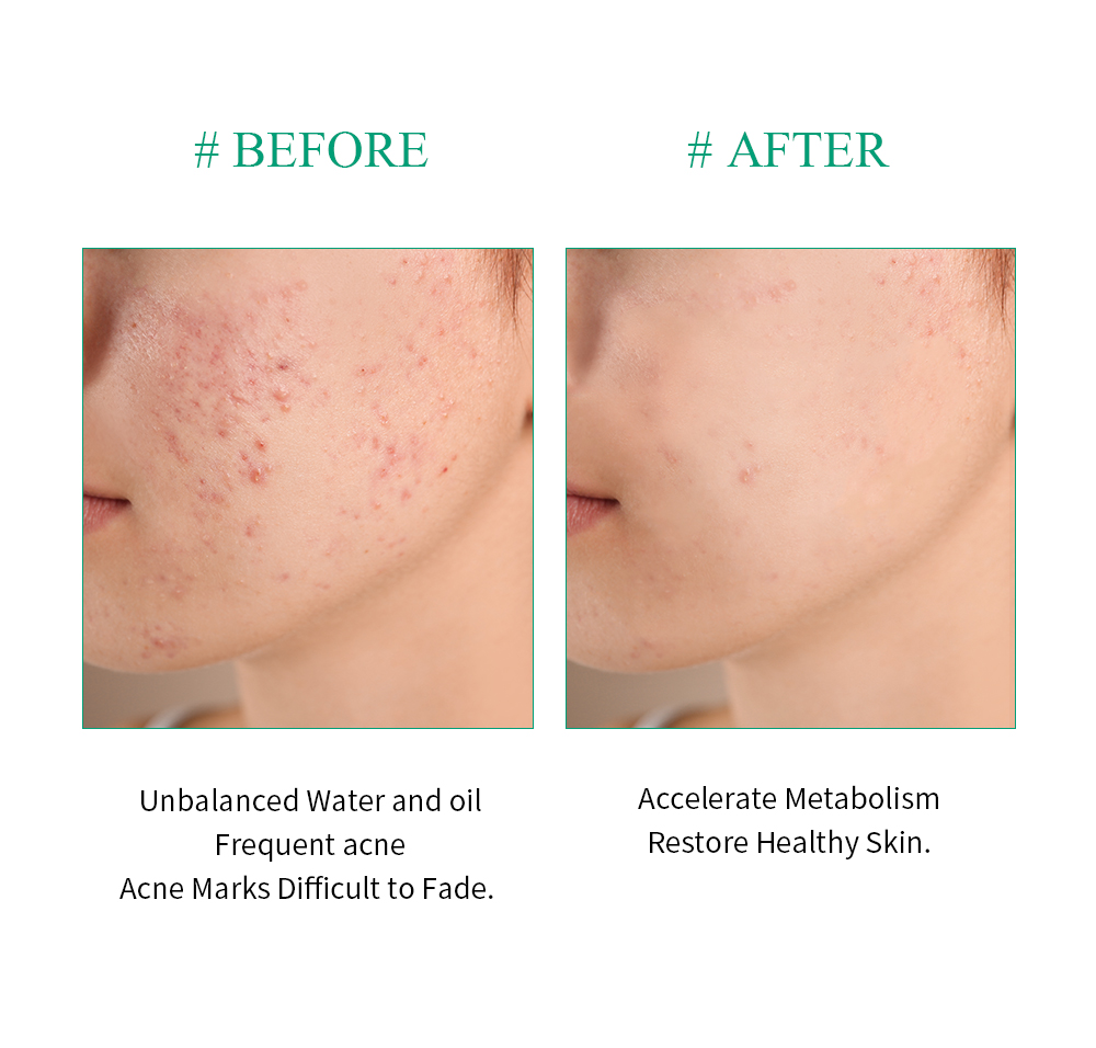 BREYLEE Acne Scar Repair Ceam Acne Treatment Gel Scar Fading Scar Acne ...