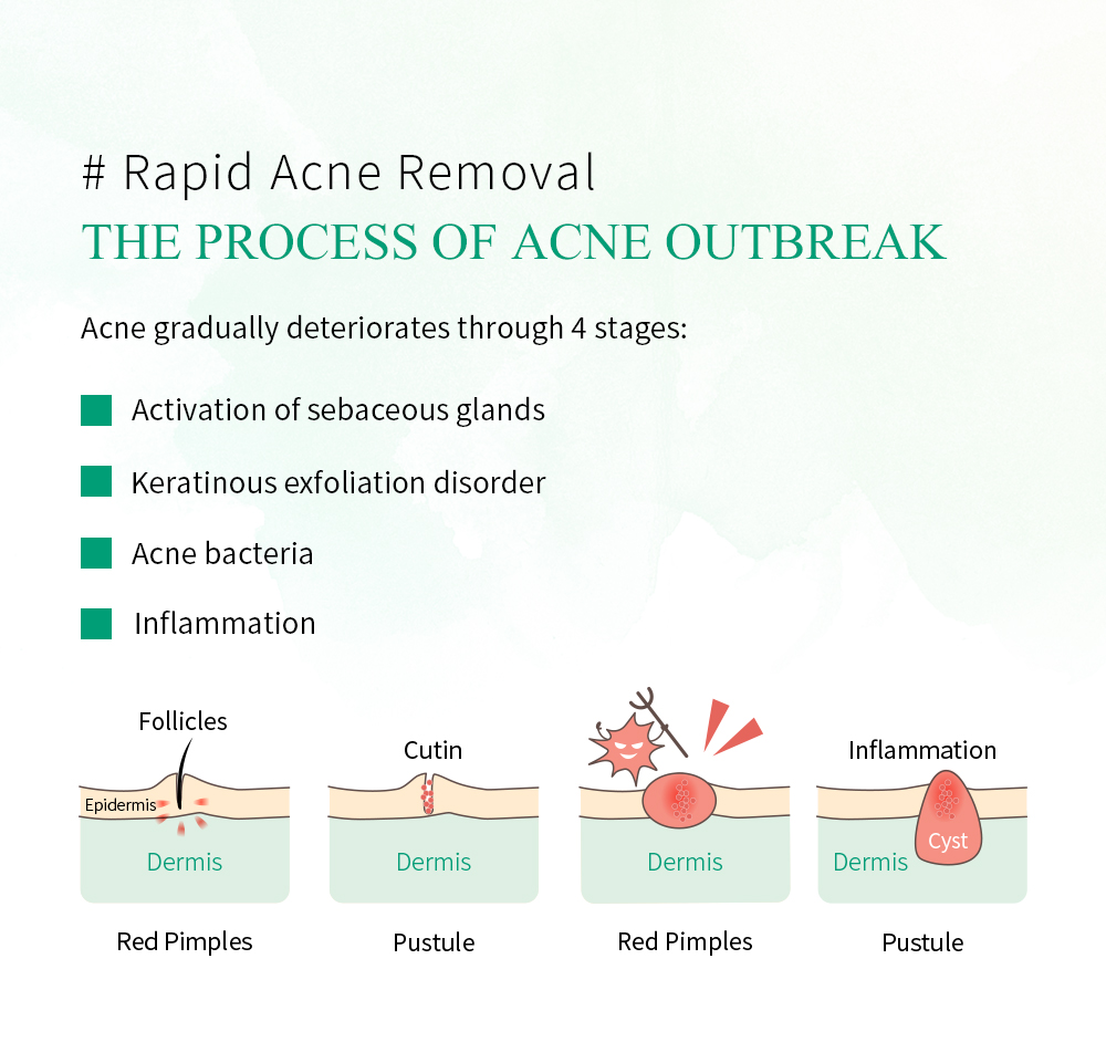 BREYLEE Acne Scar Repair Ceam Acne Treatment Gel Scar Fading Scar Acne ...