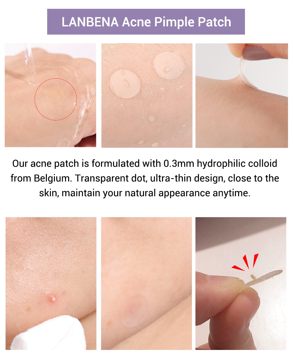 Lanbena Pimple Patch Acne Treatment Patch Acne Stickers Blemish Pimple ...