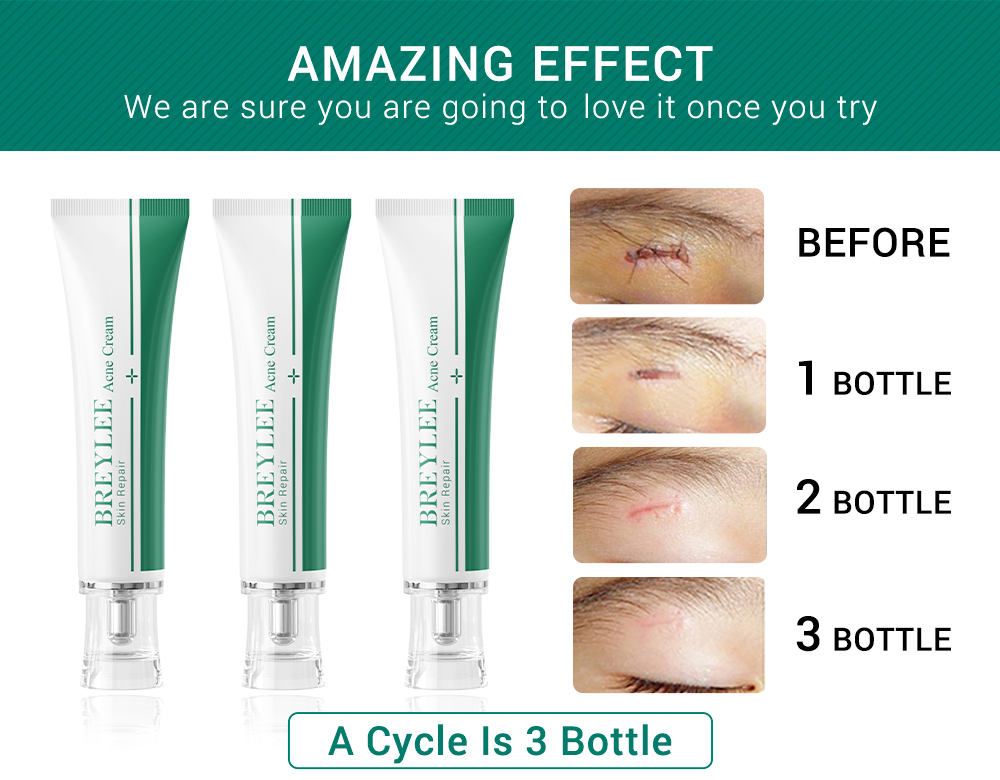 BREYLEE Acne Cream Scar Repair Gel Pimple Acne Treatments Scar Acne Remove Cream Fade Marks ...