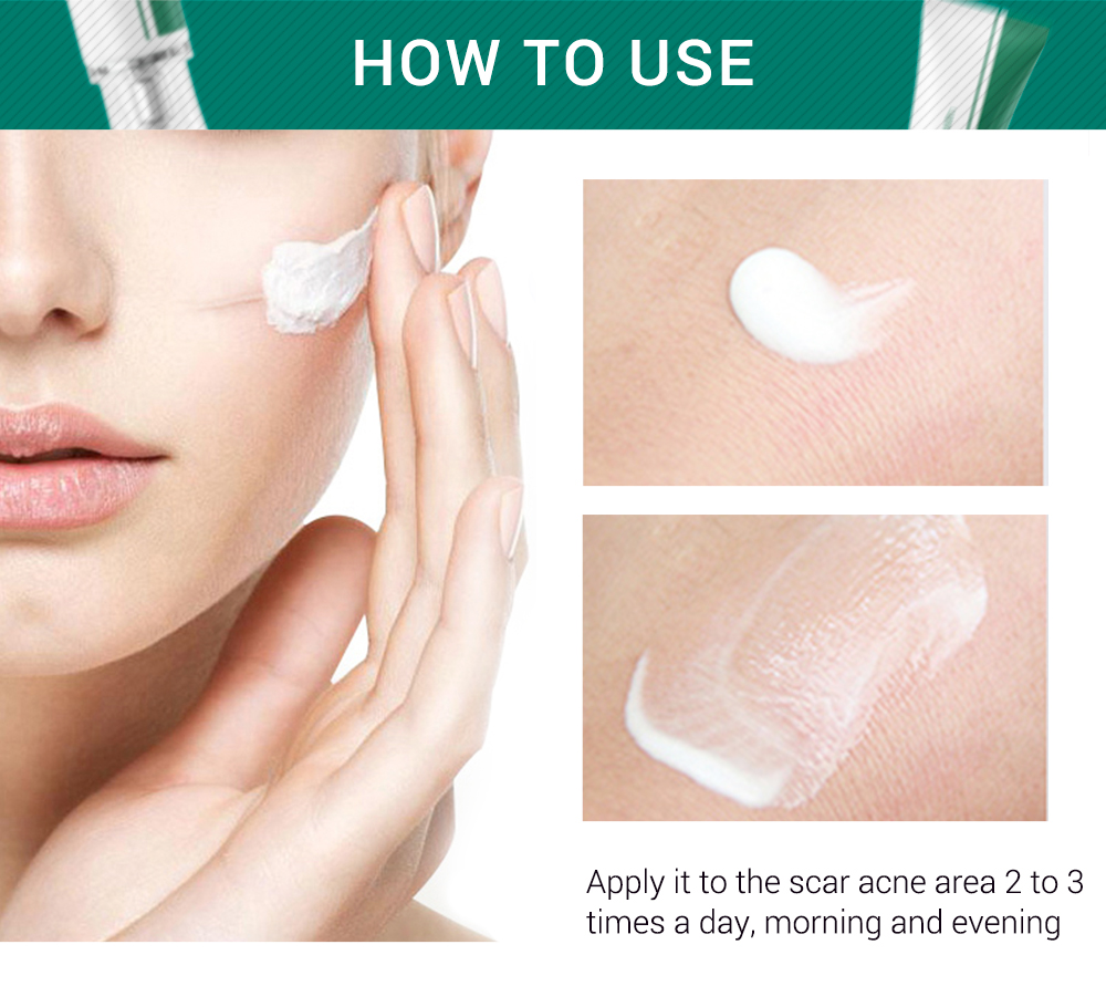 BREYLEE Acne Cream Scar Repair Gel Pimple Acne Treatments Scar Acne ...