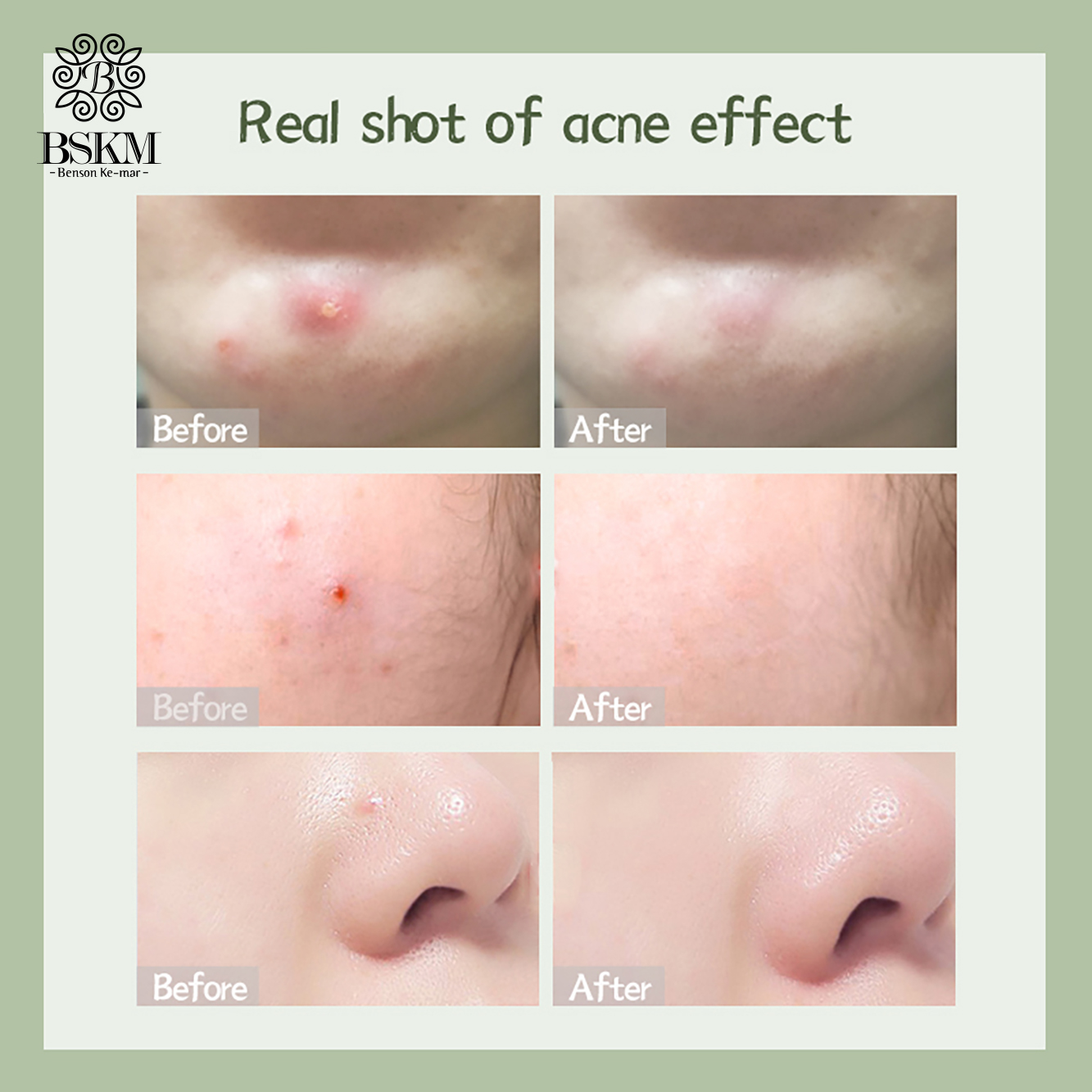 BSKM Tea Tree Acne Patch Night Pimple Patch Invisible Acne Sticker ...