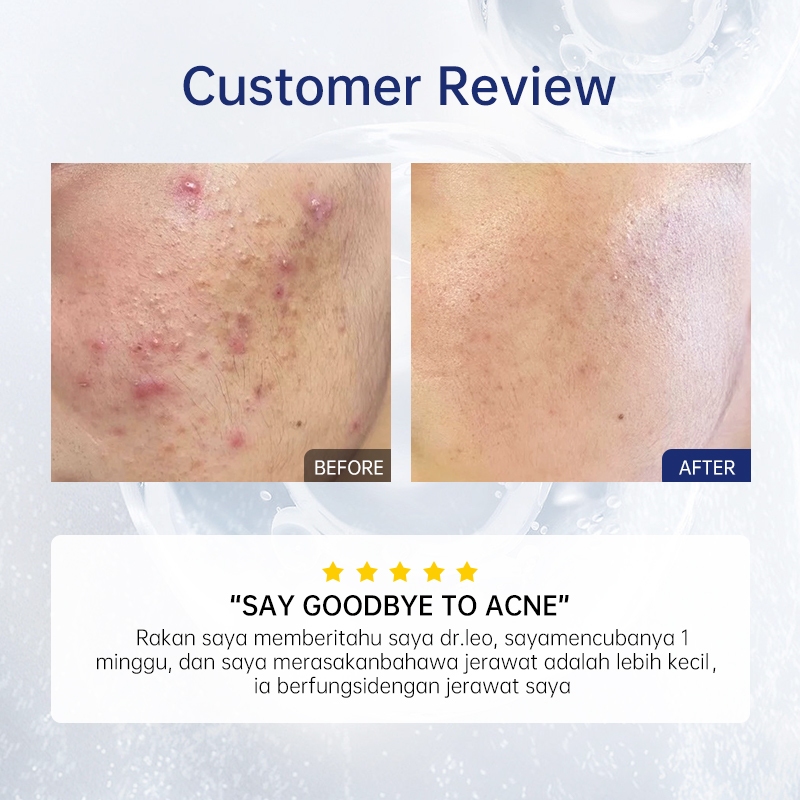 [Dr.Leo Acne Solution Set ]Acne Removal Blackhead Removal Improved Acne ...