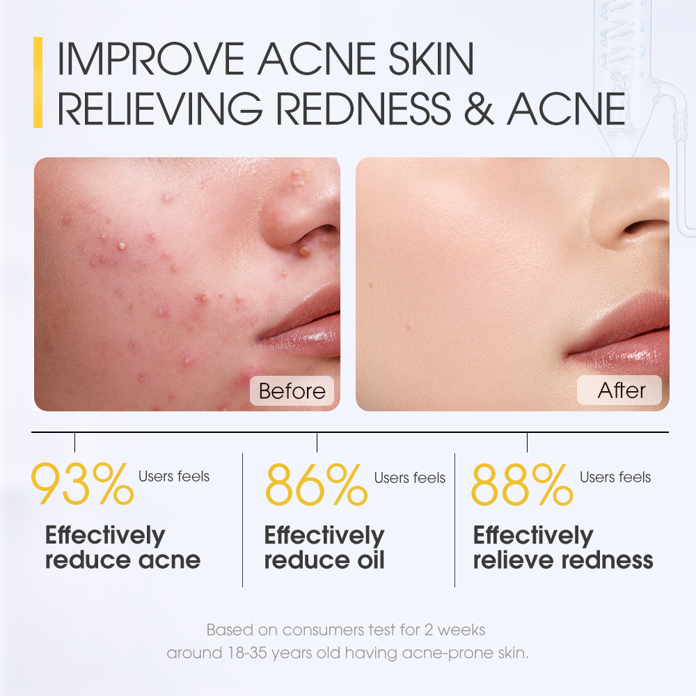 SKINEVER Salicylic Acid Acne Treatment Masque Acne Relief Soothing and ...