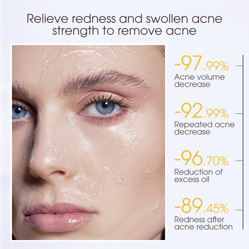 SKINEVER Salicylic Acid Acne Treatment Masque Acne Relief Soothing and ...