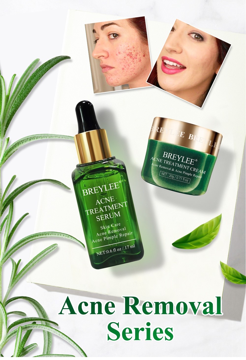 BREYLEE Tea Tree Acne Treatment Set Acne Serum 17ml + Acne Cream 20g | Shopee Philippines