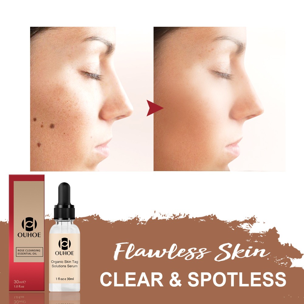 OUHOE Organic Skin Tag Solutions Serum Rose Cleansing Essential Oil ...