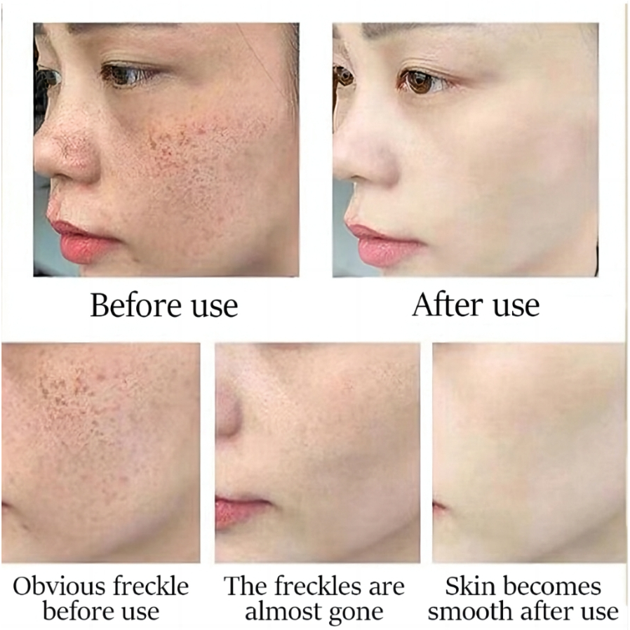 CT Japanese Melasma Cream 30g Replenish Collagen Whiting For Face Pekas ...