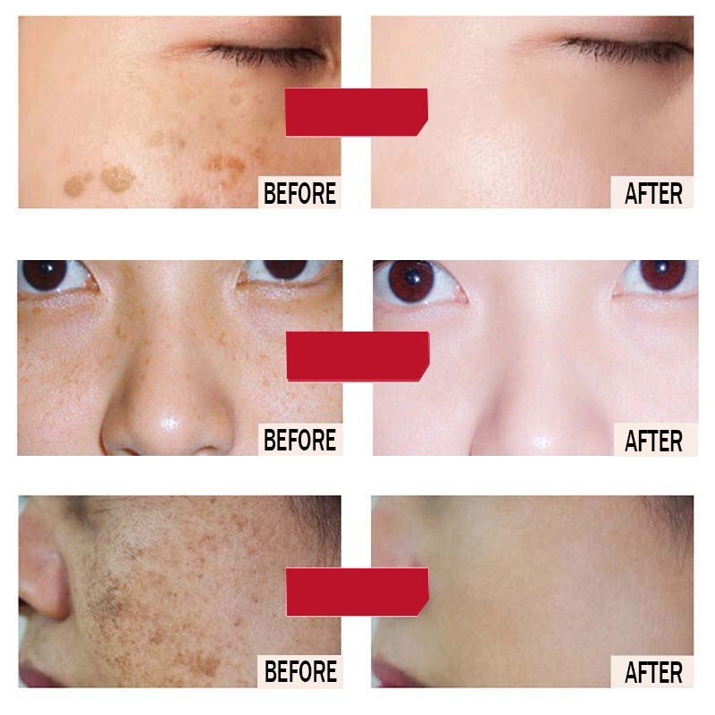 30g Chloasma Whitening Cream Eliminate dark spots and brighten skin ...