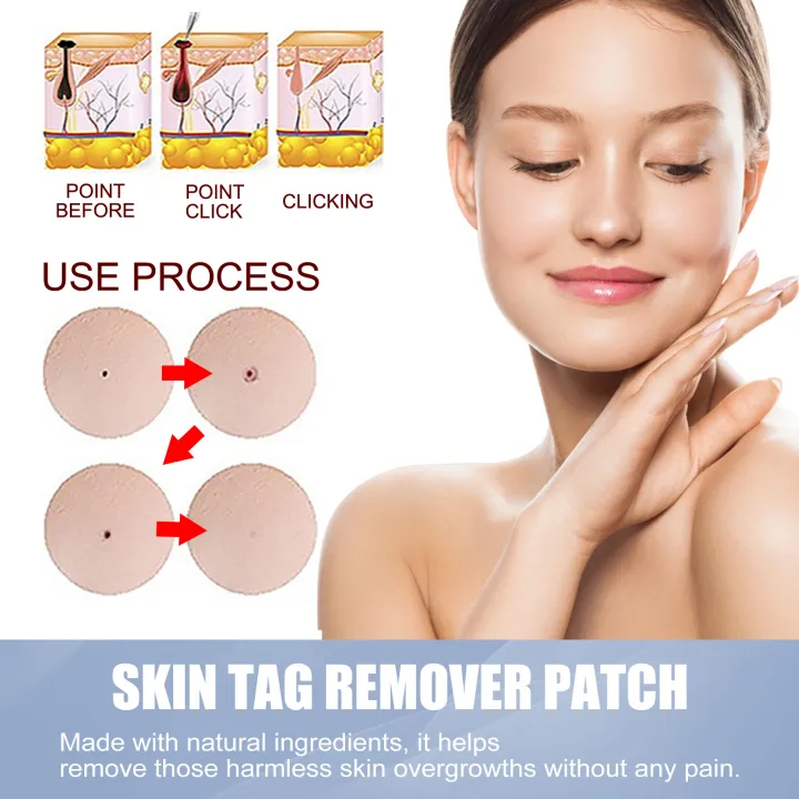 144PCS/Box Warts Remover Patch Safe Painless Skin Tags Patches Pimple ...