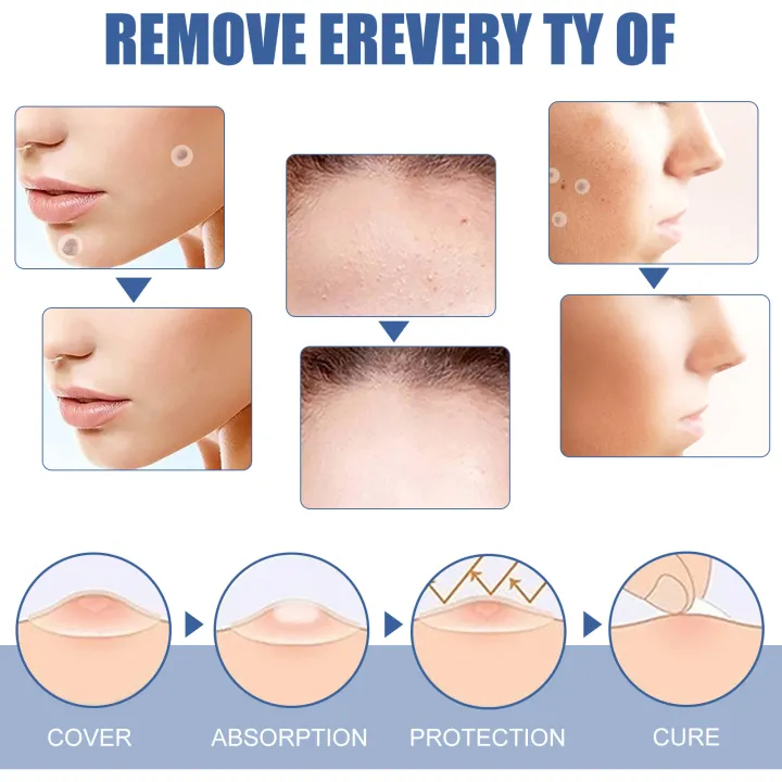 144PCS/Box Warts Remover Patch Safe Painless Skin Tags Patches Pimple ...