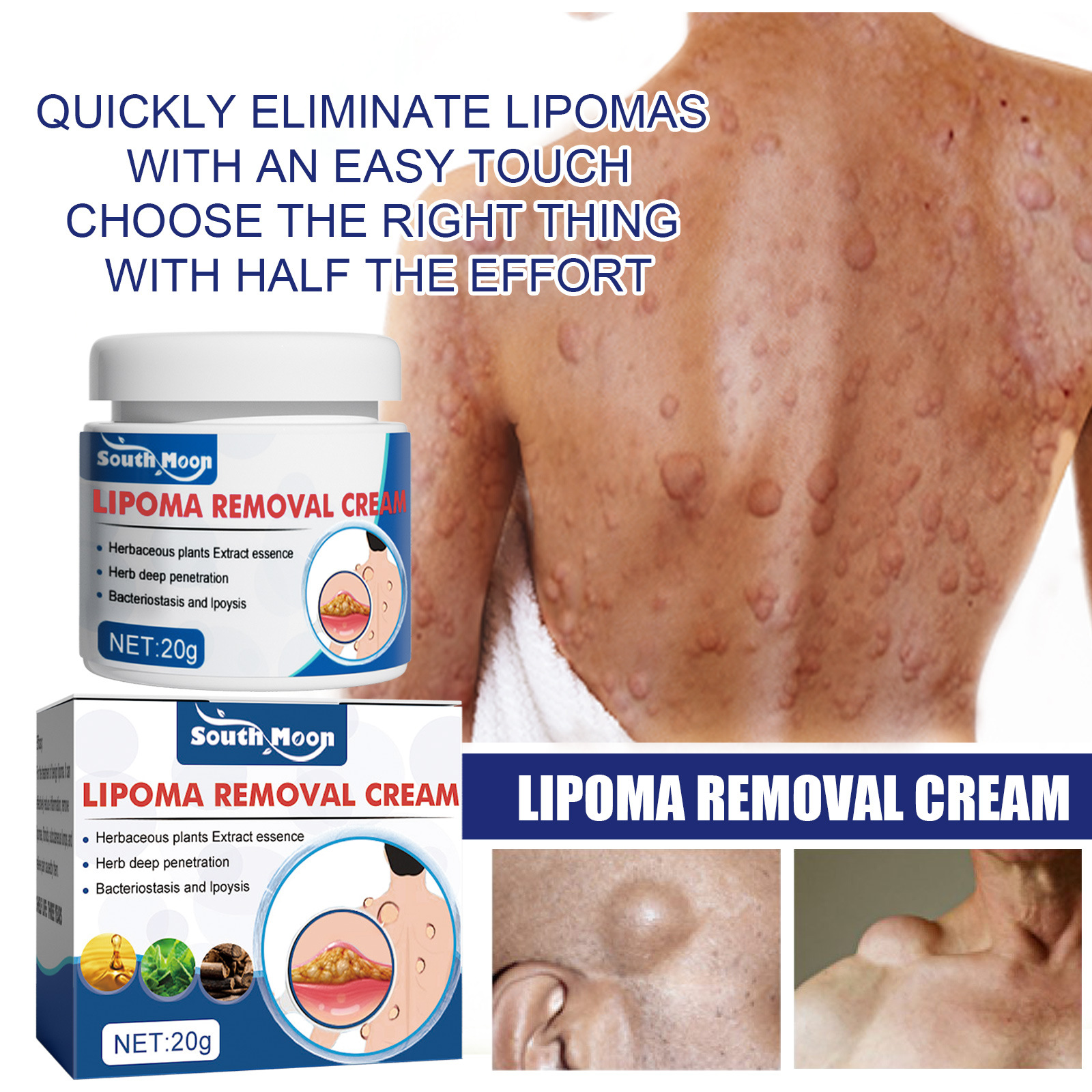 Lipoma removal cream original lipoma ointment japan lipoma cream ...