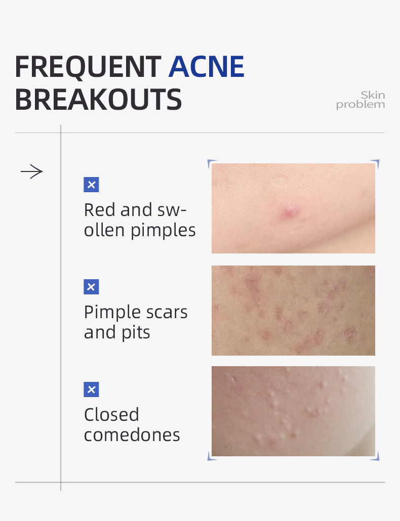 ICE LERSKIN Acne Essence Salicylic Acid Anti-acne Serum Fades Acne ...