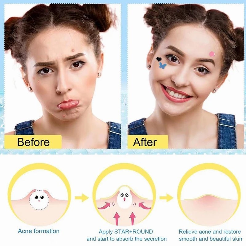 Acne Pimples แผ่นแปะสิว Cute Character Star Heart Butterfly Agne Acne ...