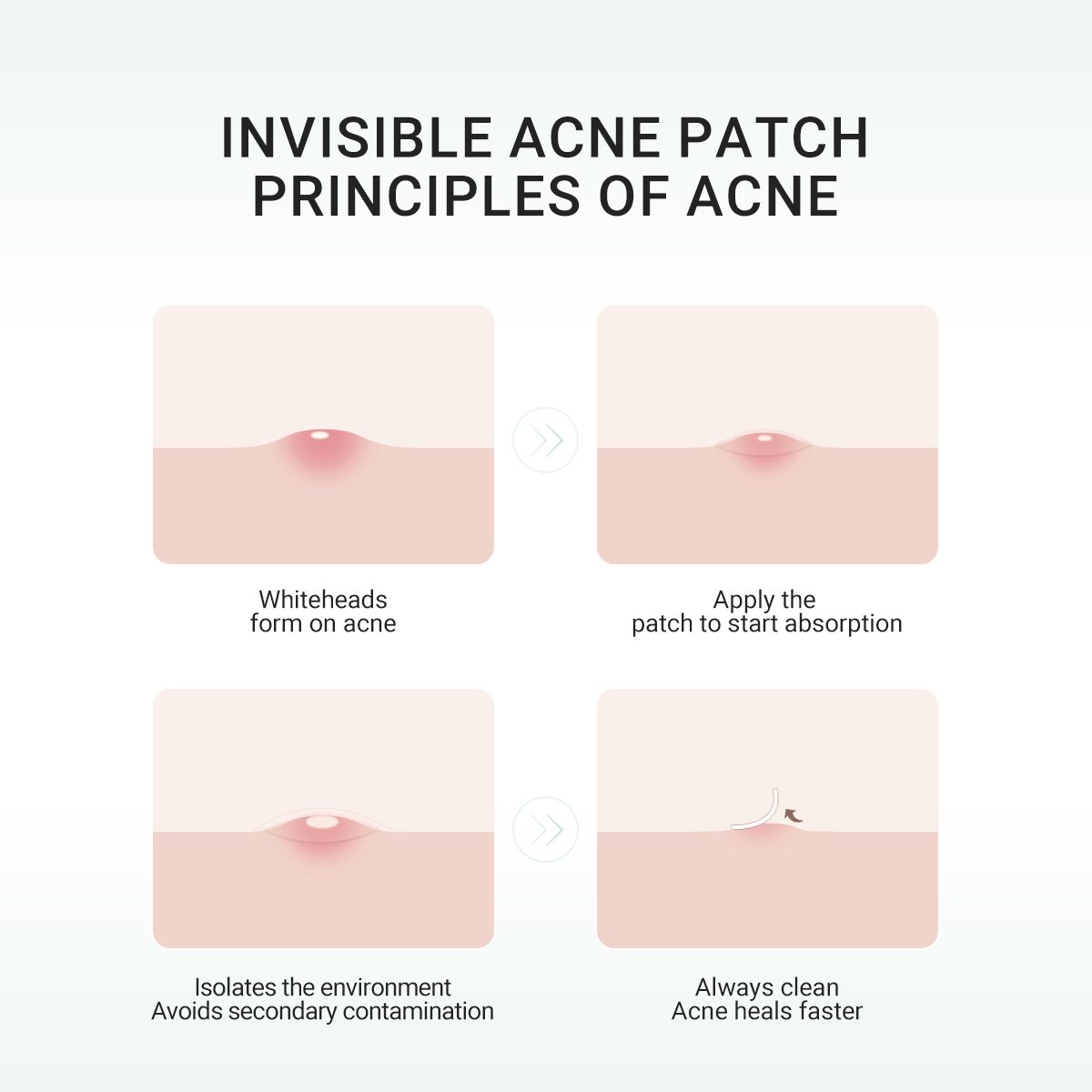 LANBENA Pimple Patch Acne Treatment Patch Acne Stickers Blemish Pimple ...