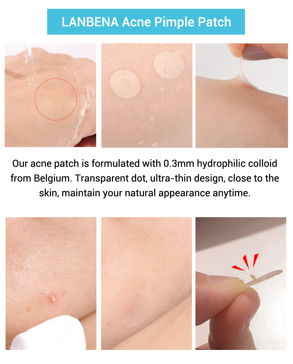 LANBENA Pimple Patch Acne Treatment Patch Acne Stickers Blemish Pimple ...