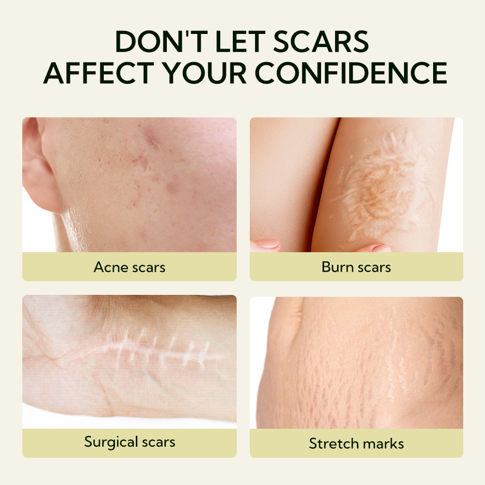 LANBENA Scar Remover Set Acne Scar Removal Gel and Serum Fade Stretch ...