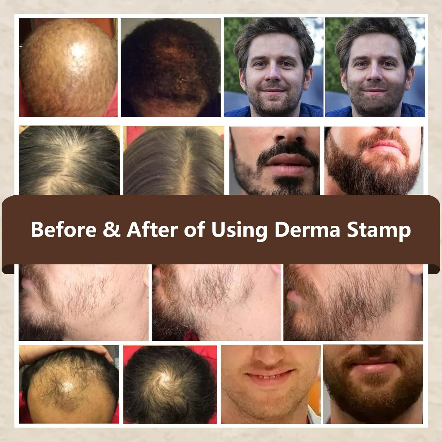 DRS 140A By Dr.pen Adjustable microneedling Derma Stamp,Professional ...