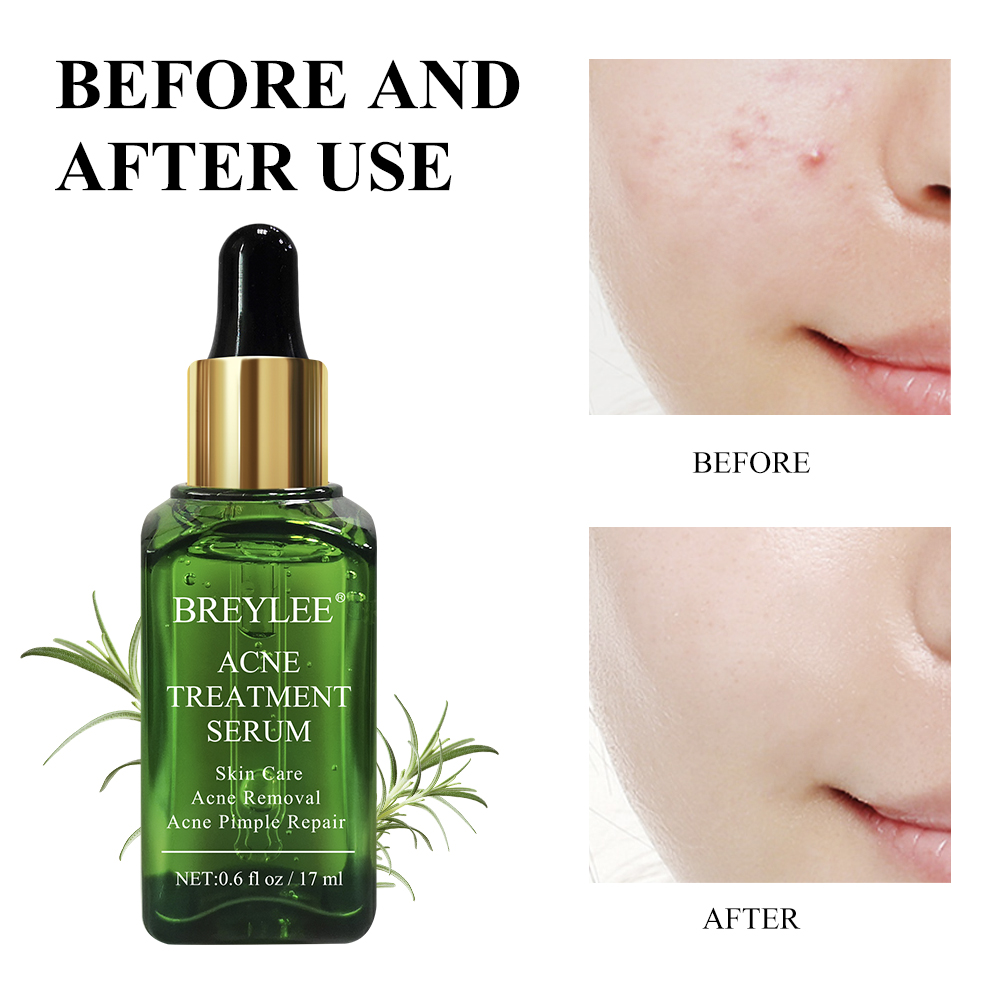 Breylee Acne Treatment Set Acne Skin Care Set Scar Treatment Face Serum Face Cleanser Cream ...
