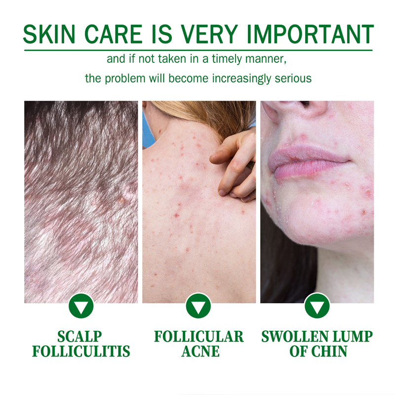 Hair Follicle Cream Folliculitis Cream Skin Care Natural Ingredients ...