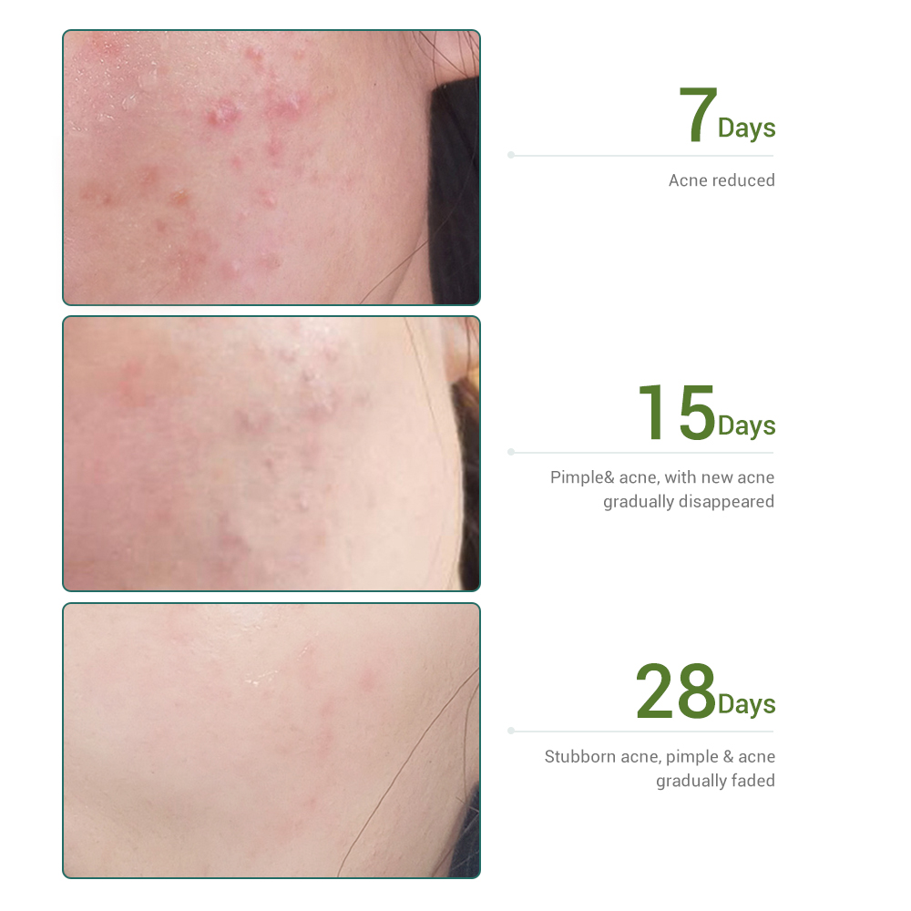 Breylee Acne Treatment Set Acne Skin Care Set Scar Treatment Face Serum Face Cleanser Cream ...