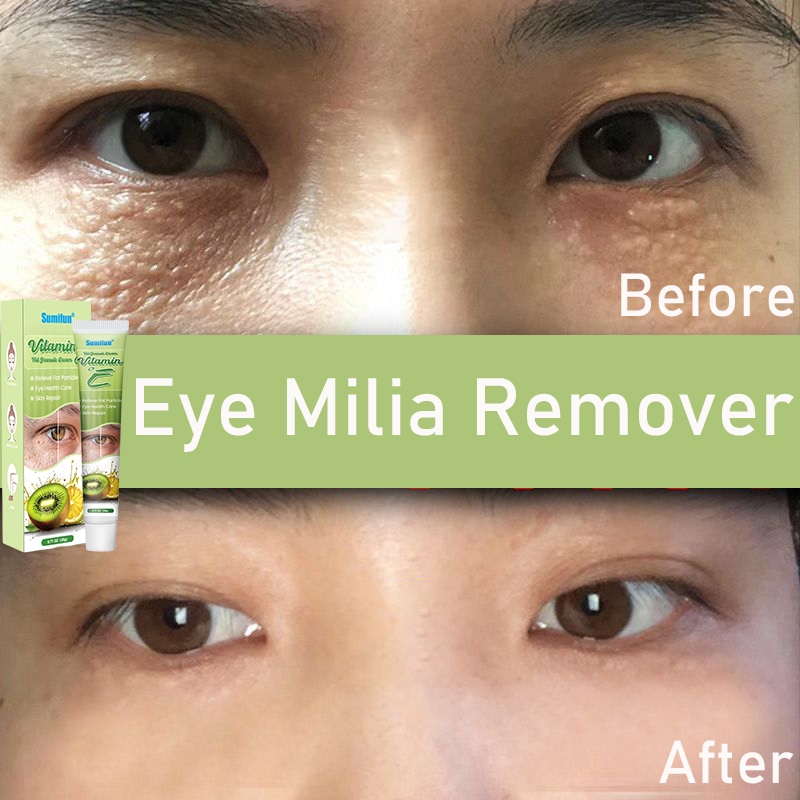 20g milia remover eye cream krim milia seed remover biji kolestrol ...