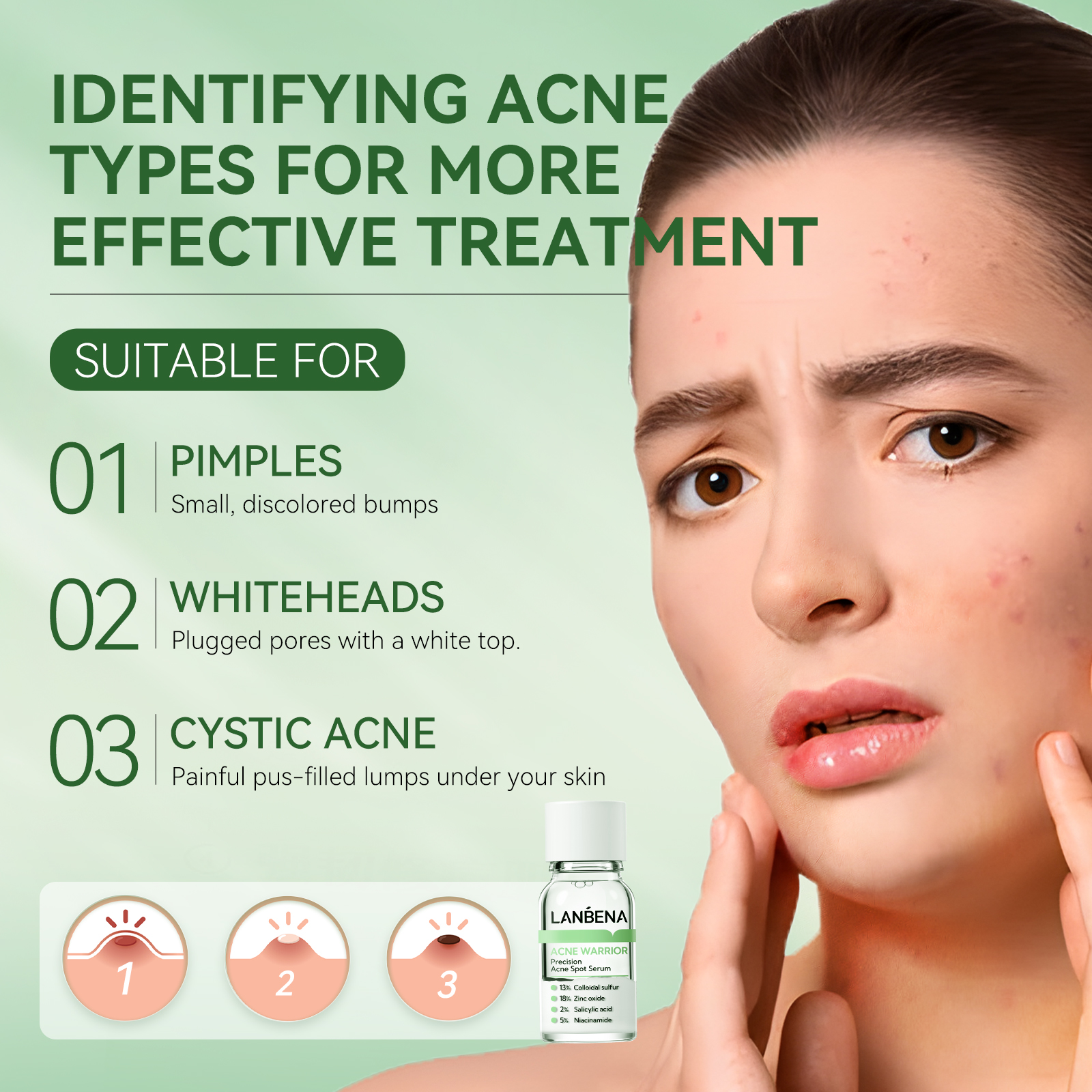 LANBENA Acne Essence Salicylic Acid Anti-acne Serum Lighten Acne Scars ...