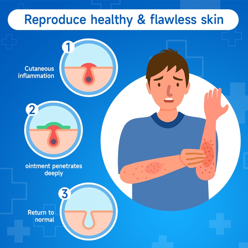 DERMFREE Eczema Relief Body Cream Psoriasis Cream Dermatitis Eczema ...