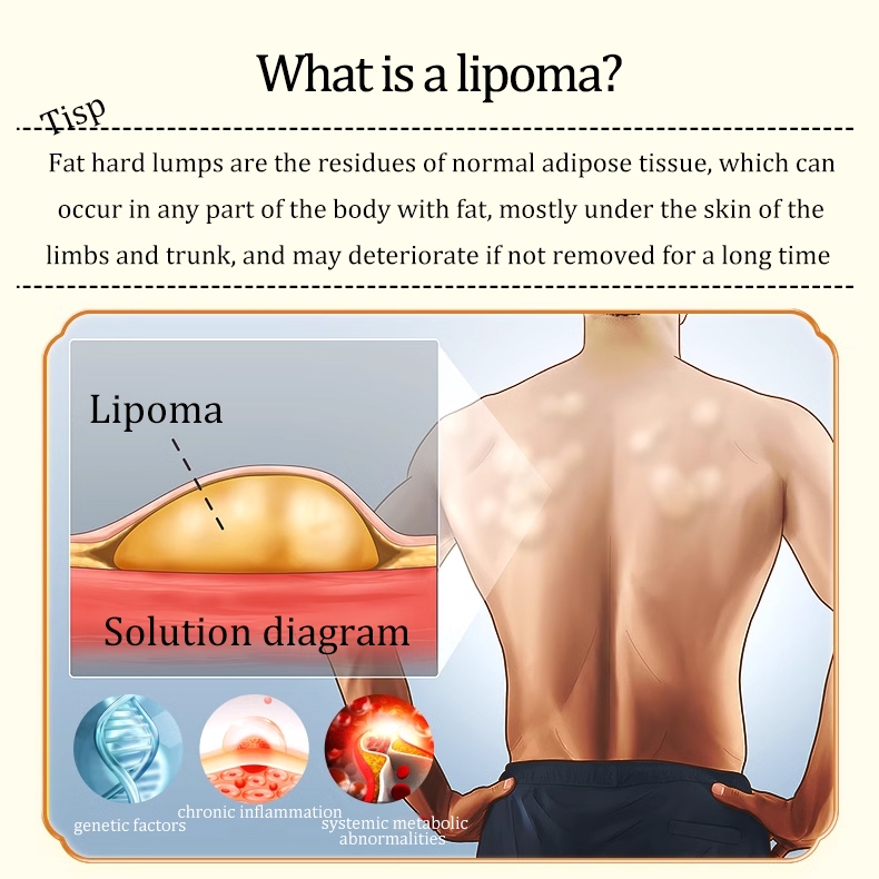 OUHOE Lipoma Removal Cream 20g original lipoma cream Fat Lump lipomas ...