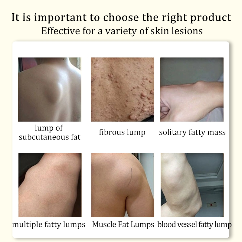 OUHOE Lipoma Removal Cream 20g original lipoma cream Fat Lump lipomas ...