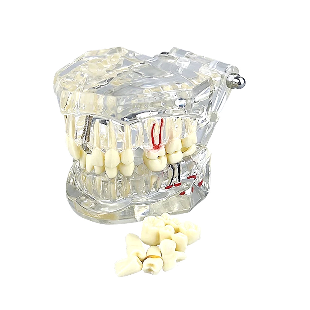 Dental Model Teeth Implant Restoration Bridge Teaching Study Typodont ...