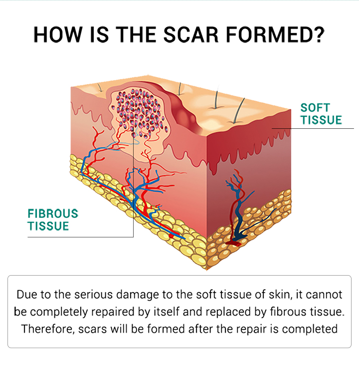 BREYLEE Scar Repair Acne Scar Removal Cream Stretch Mark Acne ...