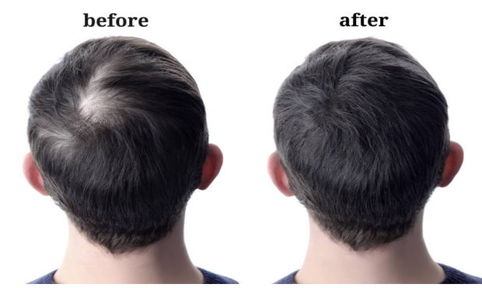 Minoxidil 15% Hosoku Hair Growth(with collagen and castor oil) Hair ...