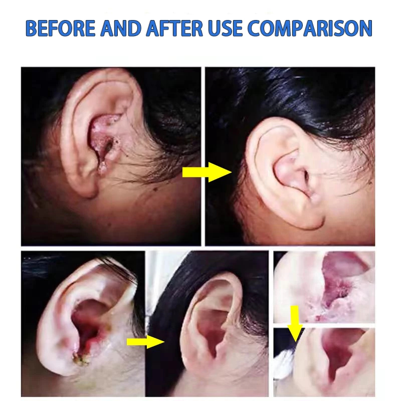 Ear Drops Treatment Original Tinnitus liquid Ear Drops Hearing Loss ...