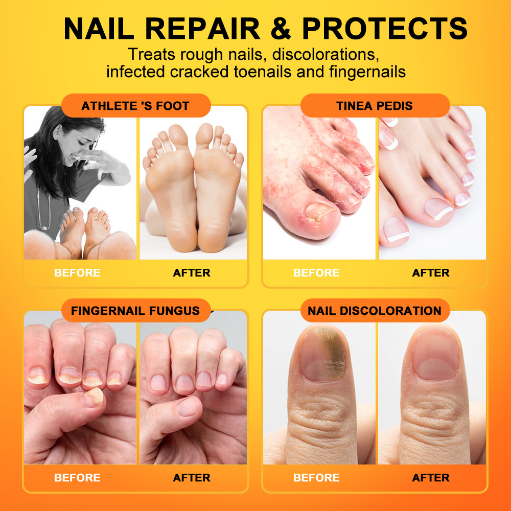 3 in 1 Bee Venom Foot Spray For Nail Fungus Athlete's Foot Tinea Pedis ...