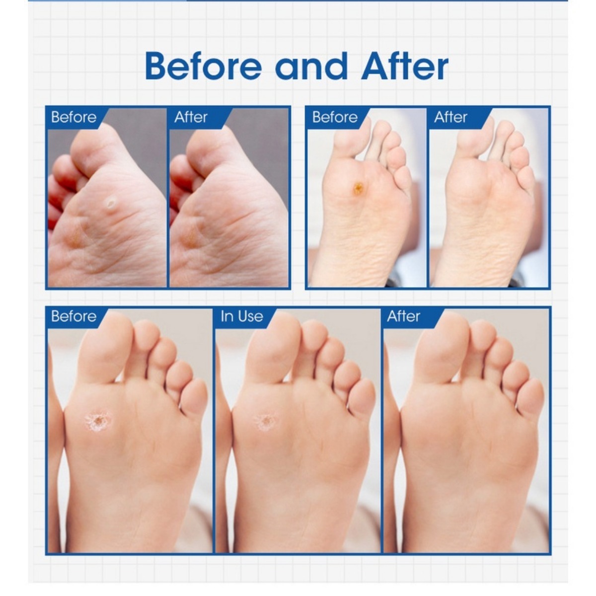Wart Removal Patches for Feet - Medicated Corn Callus Treatment with ...