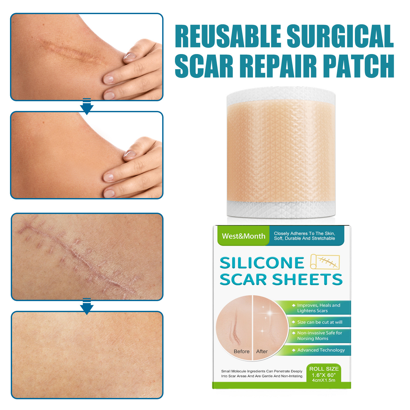 West&Month Silicone Scar Patch Self-Adhesive Stretch Mark Repair Strip ...