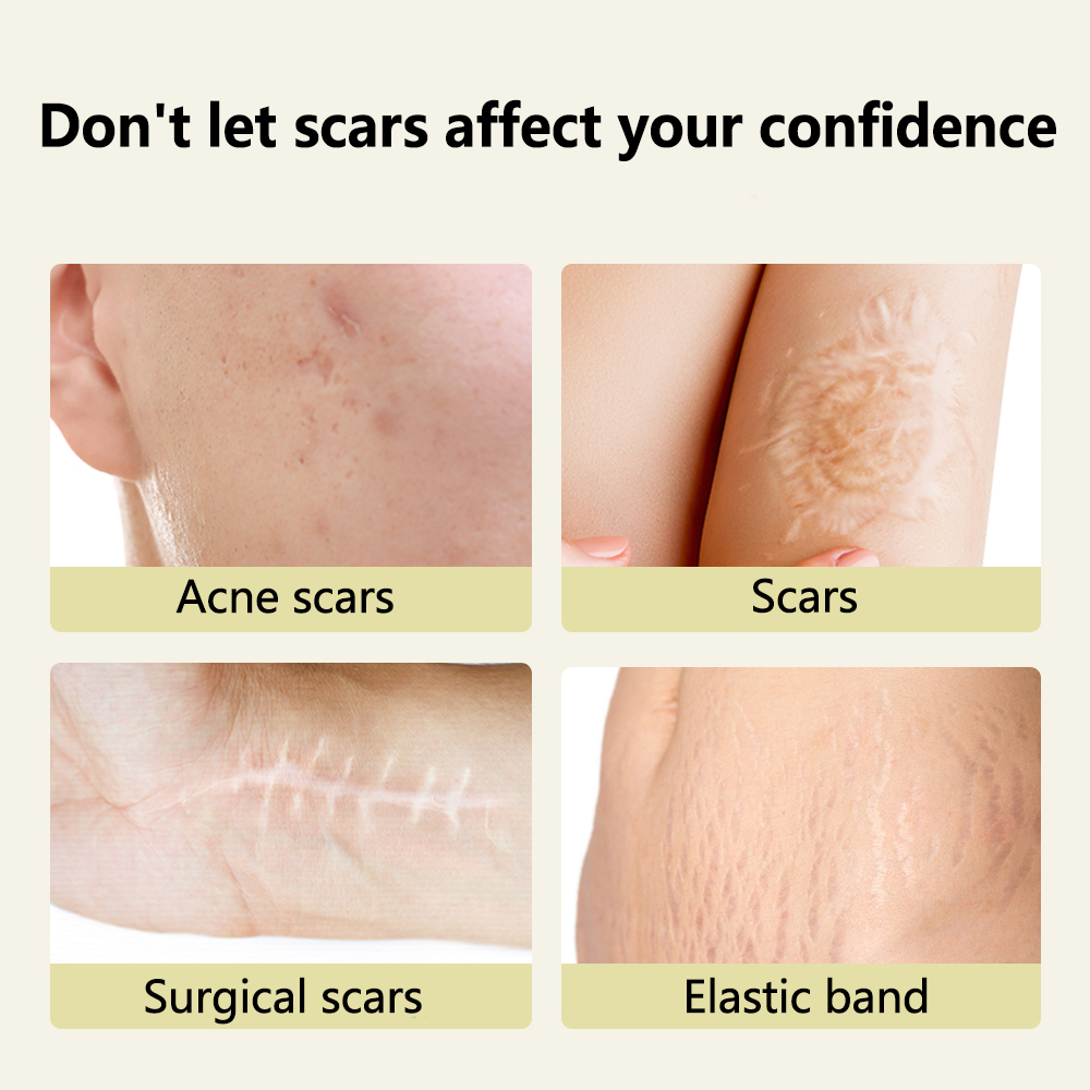 【Genuine】Scar Removal Cream Scar Remover Acne Scars Stretch Mark ...